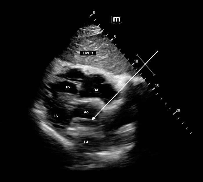 Code Stroke :: POCUS